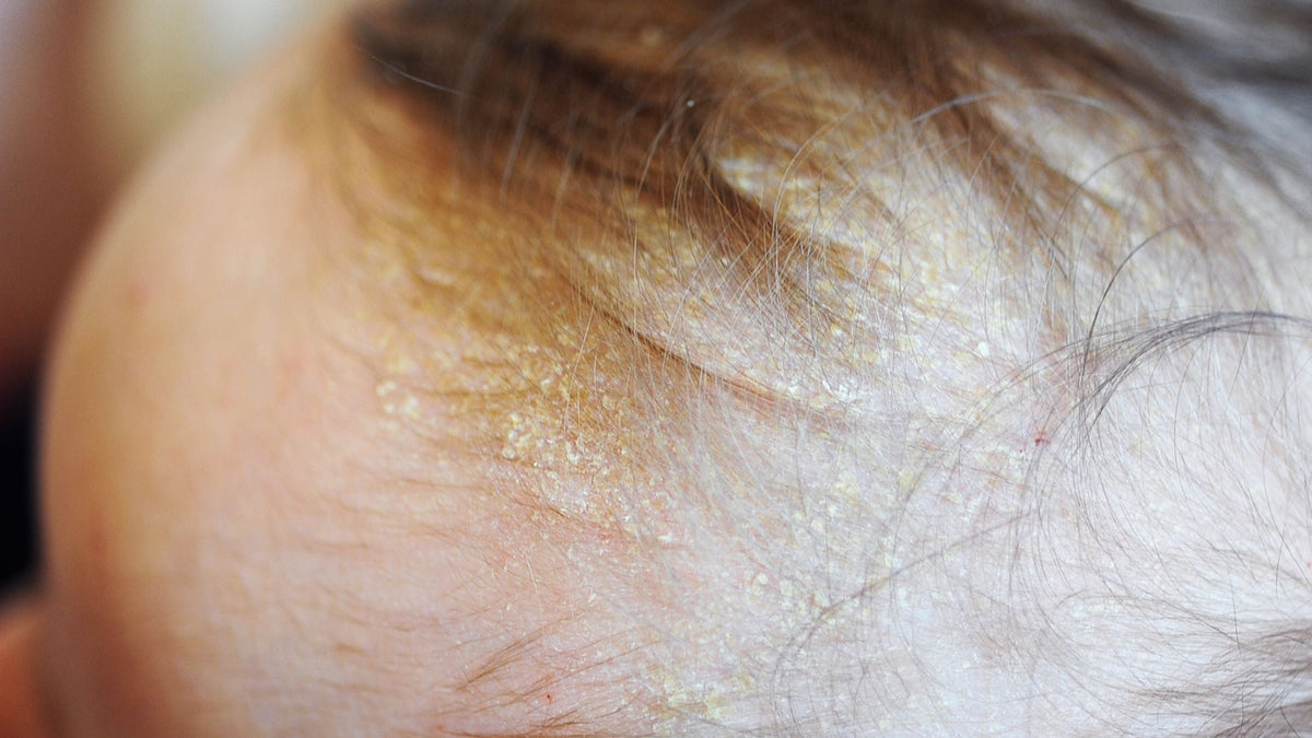 What Is Cradle Cap and What Can You Do to Help It?– Itchy Baby Co.